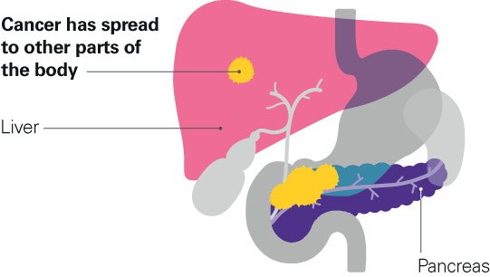 A Treatment And Surgical Option For Pancreatic Cancer In USA